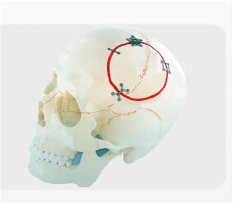 Titanium Cranial Implant At ₹ 2000 Piece In Ahmedabad Id 2851649010448
