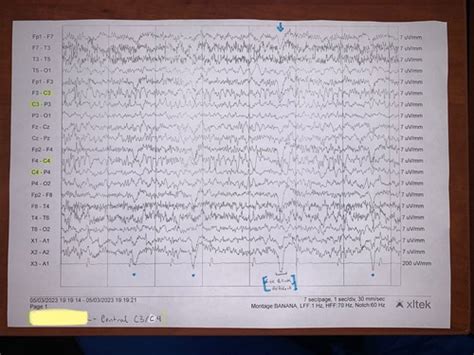 Normal Variants 👍 Flashcards Quizlet