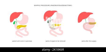 Medical Infographic Of Whipple Procedure Pancreaticoduodenectomy With