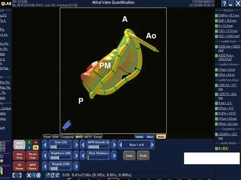 Transesophageal Echocardiography Advanced Echocardiography Concepts Clinical Tree