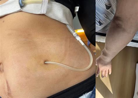 Баттуяа 2022оноос хойш одоог хүртэл намайг амьдаруулж байгаа хэвлийд тавиулсан гуурс маань