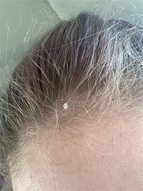 Dandruff Dry Scalp Psoriasis Rdandruff