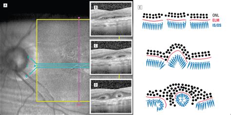 Different Configurations Of Outer Retinal Tubulation Ort Overlaid