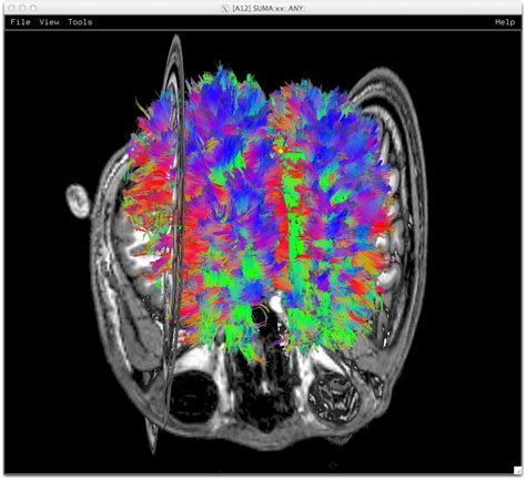 62 Suma Viewer — Afni Suma And Fatcat V25100