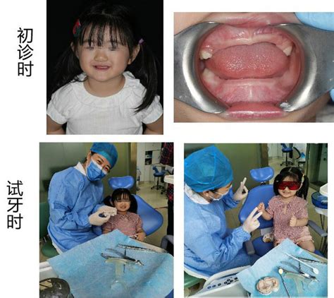 “先天缺牙”十万分之一发病率的小禾禾有牙了kq88口腔新闻
