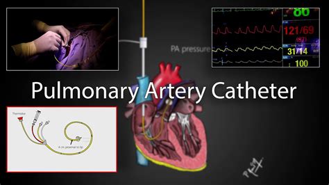Pulmonary Artery Catheter Swan Ganz Catheter Placement And Physiology Youtube