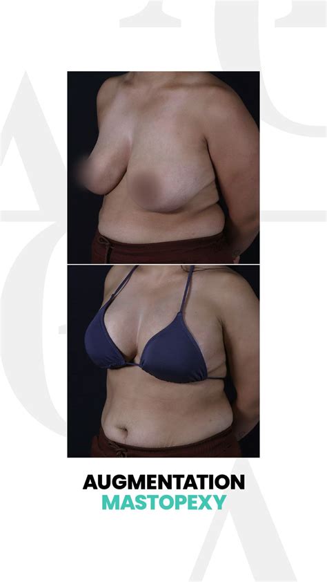 After Breast Reduction Surgery Before And After Pregnancy