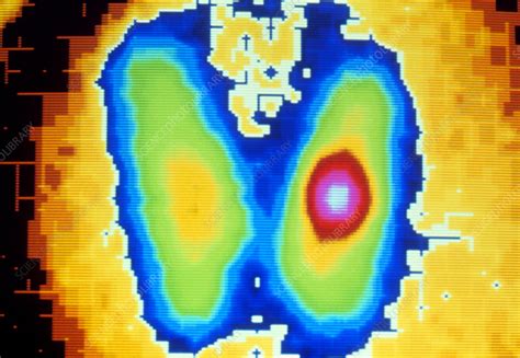 Coloured Gamma Scan Of Benign Thyroid Adenoma Stock Image M108 0346 Science Photo Library