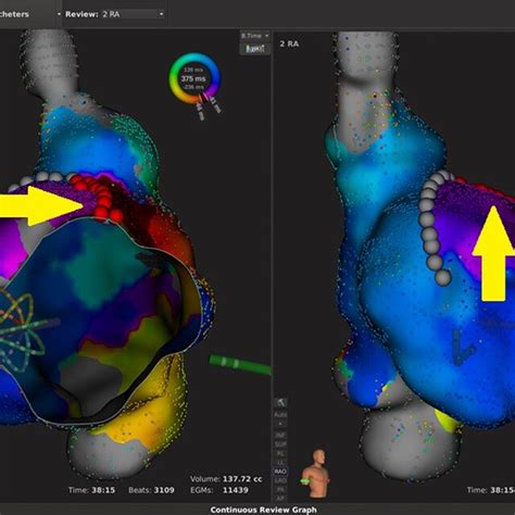 Atrial Flutter Interruption During Radiofrequency Catheter Ablation Download Scientific Diagram