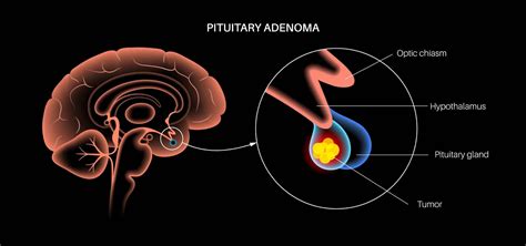 Pituitary Adenoma Tumour And Prolactinoma
