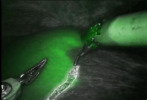 The Clear Demarcation Between Right And Left Lobe Liver In Icg