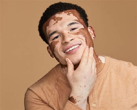 Vitiligo Model Vitiligo Fact Sheets Yale Medicine