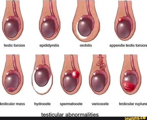 Testic Torsion Epididymitis Appendix Testis Torsion Testicular Mass
