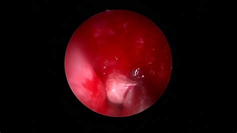 Endoscopic Microdebrider Adenoidectomy Youtube
