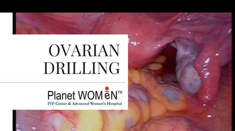 Ovarian Drilling By Laparoscopy For Pcos Youtube