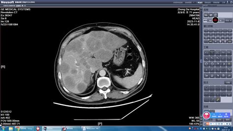 Javascriptvoid0 Hepatoid Adenocarcinoma Of Stomach With Simultaneous