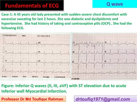 Approach To A Patient With Q Wave Abnormality In Ecg Ppsx