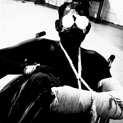 External Ocular Diseases Best Eye Doctor In Dhaka And Chattogram