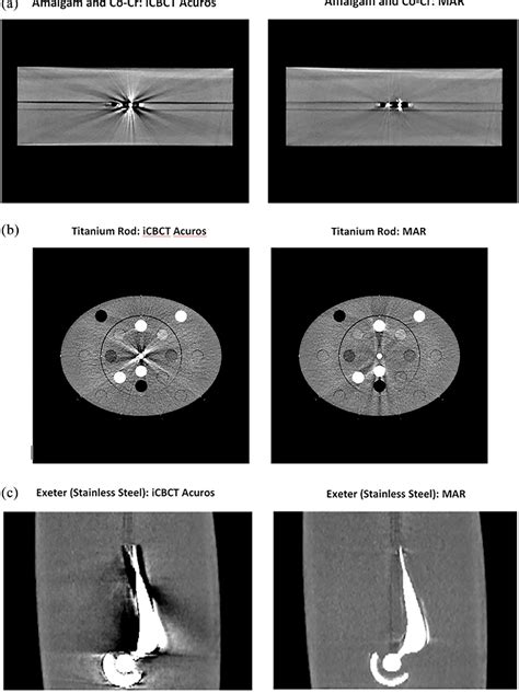 Figure 5 From Evaluation Of A Metal Artifact Reduction Algorithm For Image Reconstruction On A