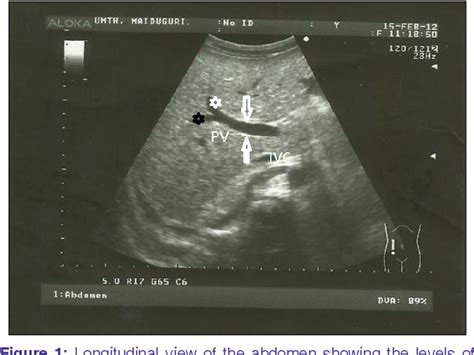 Right Portal Vein Ultrasound