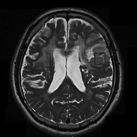 Setting Voi Of Mr Spectroscopy Voi Were Single Voxel Spectroscopy And Download Scientific
