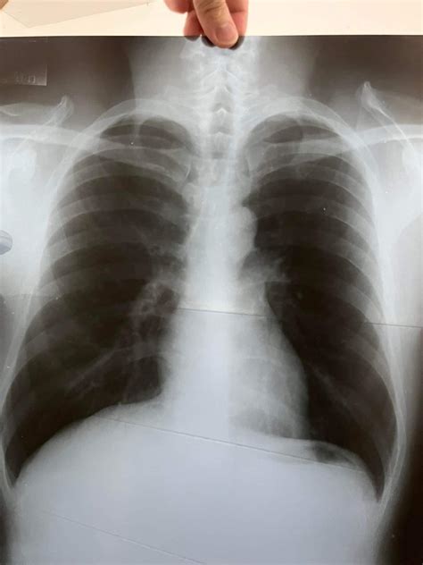 Interpret My Xray Result Please R Medical Advice