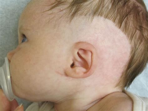 Earwell™ Archives Wilson Plastic Surgery