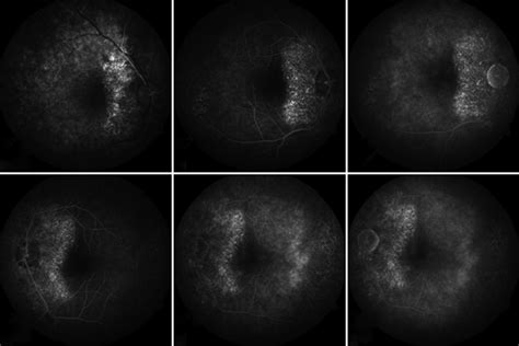 Fundus Fluorescein Angiogram Of Both Eyes Early Phase A And D Mid