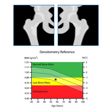 Face Bone Density At Martha Brugger Blog