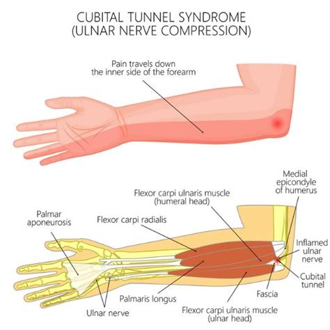 What Is Ulnar Nerve Compression At The Elbow Ulnar Nerve Ulnar Images And Photos Finder