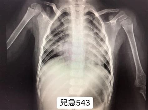 Rsv幼兒園爆發！兒醫示警「住院率飆升」 2招預防快筆記 健康大小事 生活 Nownews今日新聞