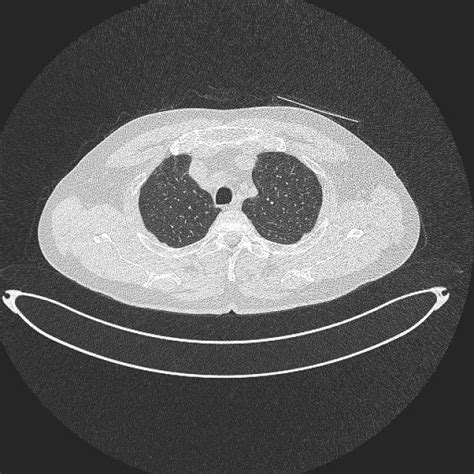 Detection Of Lung Cancer Object Detection Model V1 Lung Cancer Dataset By Capstone Project