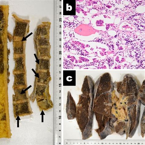 Bone Metastasis And Gross Pathology Of The Lung A Multiple Metastasis