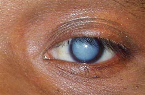 Eye Diseases 10 Common Eye Diseases