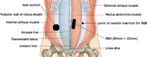 Continuous Rectus Sheath Block In A Patient With A Postoperative Rectus