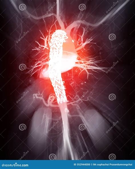 Cta Whole Aorta With Aortic Stenta Clear Visualization Of The Aorta
