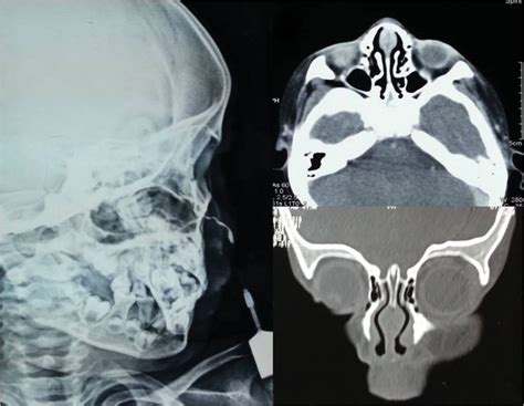 Sinogram And Ct Scan Revealing Cyst With Single Tract Going Under Nasal