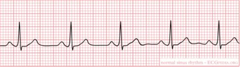 Management Of Patients With Arrythmias And Conduction Problems Flashcards Quizlet