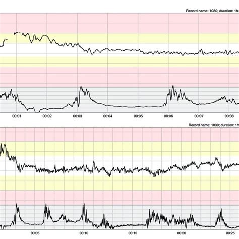 A Segment Of Ctg Recording From An Open Access Intrapartum Ctg Database Download Scientific