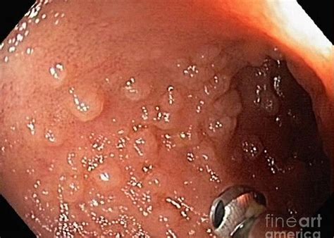 Intestinal Lymphoid Hyperplasia Greeting Card By Science Photo Library