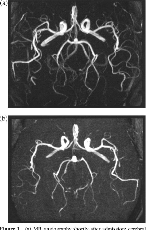Figure From Cerebral Vasculitis In A Patient With Hereditary Complete C Deficiency And