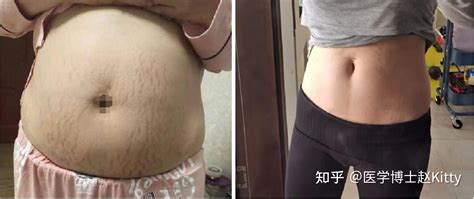 妊娠纹能去除吗？如何去除产后的妊娠纹？含具体方法和淡纹步骤