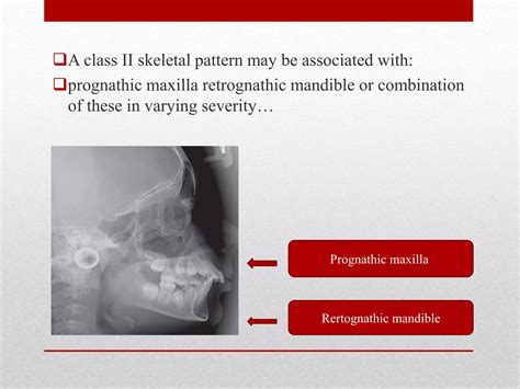 Class Ii Division 1 Malocclusion Pptx