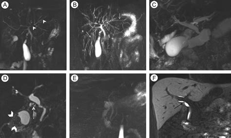 Noninvasive Imaging Of The Biliary Tree For The Interventional