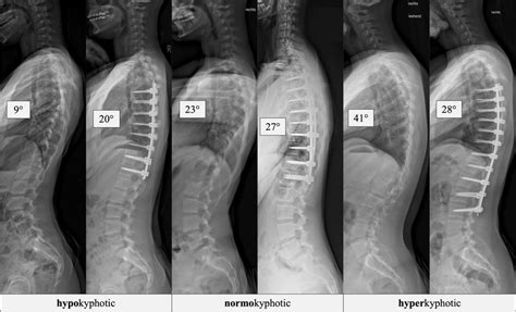 Case Demonstration For Each Sagittal Modifier In Lenke Type Cases Download Scientific