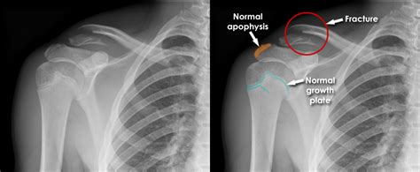Clavicle Bone X Ray
