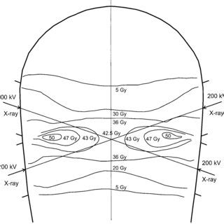 Radiation Treatment Of The Pituitary With A Four Field Technique