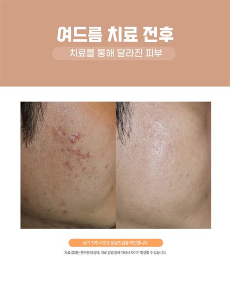 명동여드름자국 색소침착 어떻게 없앨 수 있을까