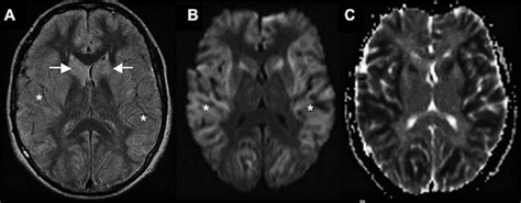Osmotic Demyelination Syndrome Bmj Case Reports