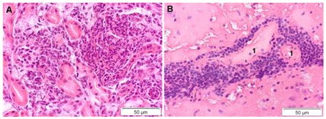 Suppurative And Non Suppurative Inflammation Of Different Organ Tissues